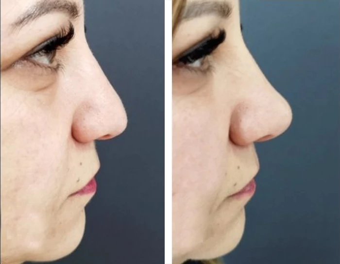 Nose Filler Before and After Photos