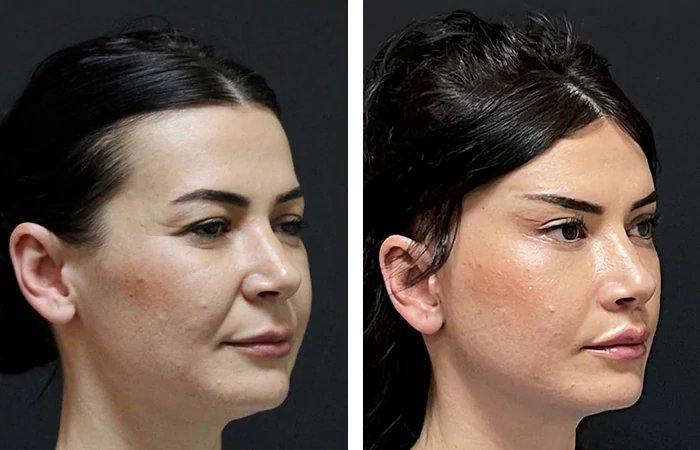 Cat Eye Surgery Before and After Photos