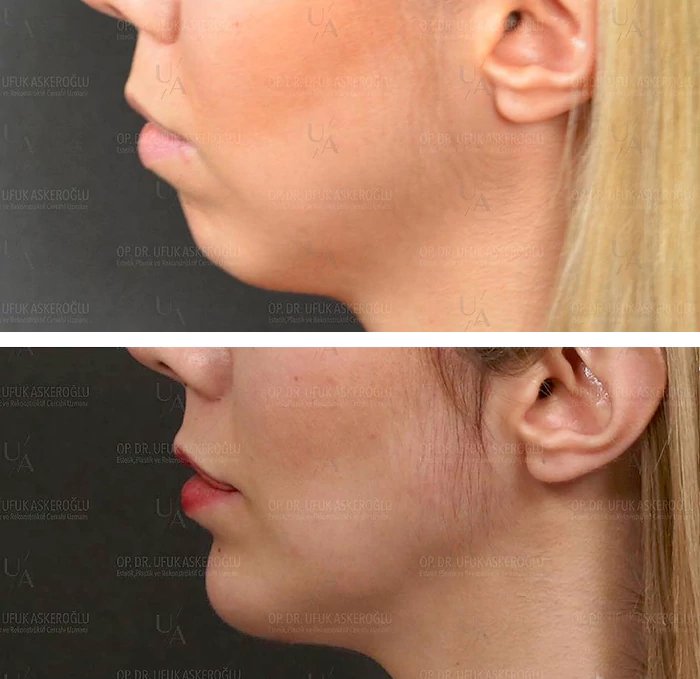 Chin Implants Before and After Photos