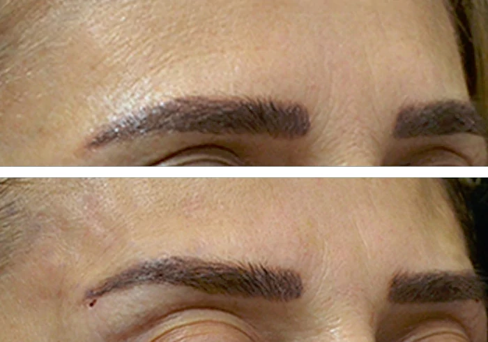 Thread Lift Before and After Photos