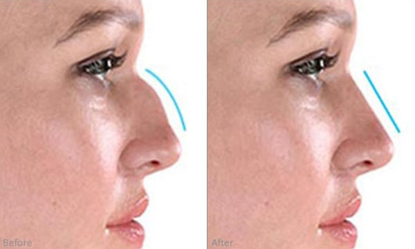 Aesthetic and Functional Nose Concerns | Belorens