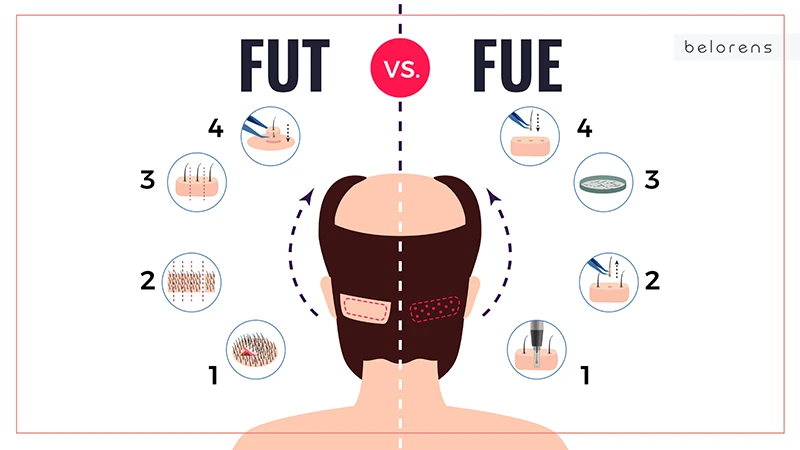 FUT vs. FUE Hair Transplant: Pros & Cons | Belorens