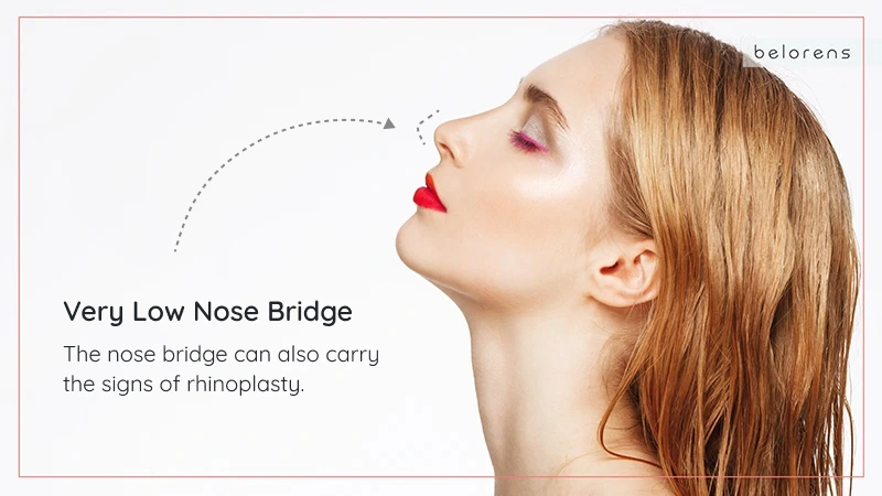 How to Tell Someone Had a Nose Job? | Belorens