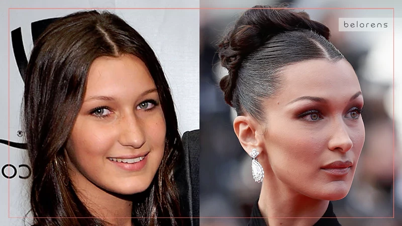 50 Celebrity Nose Jobs - before and after (Updated for 2024)
