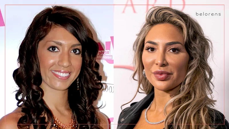 50 Celebrity Nose Jobs - before and after (Updated for 2024)