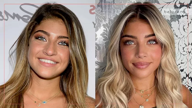 50 Celebrity Nose Jobs - before and after (Updated for 2024)