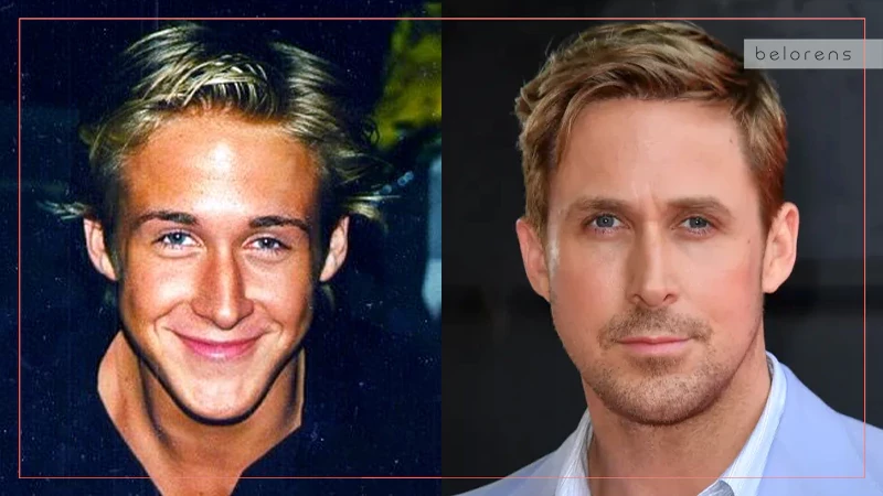 50 Celebrity Nose Jobs - before and after (Updated for 2024)