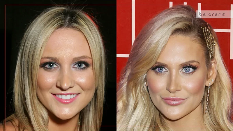 50 Celebrity Nose Jobs - before and after (Updated for 2024)