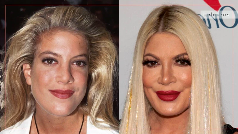 50 Celebrity Nose Jobs - before and after (Updated for 2024)