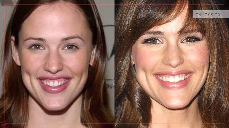 Explore Celebrity Dental Implants & Veneers | Belorens