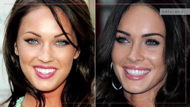 Celebrities With Dental Crowns 60 Photos - Moonagedaydream.film