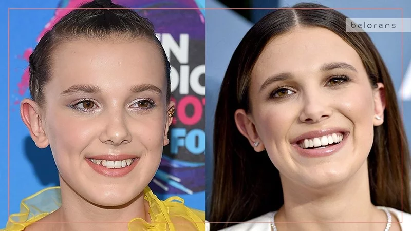 Explore Celebrity Dental Implants & Veneers | Belorens