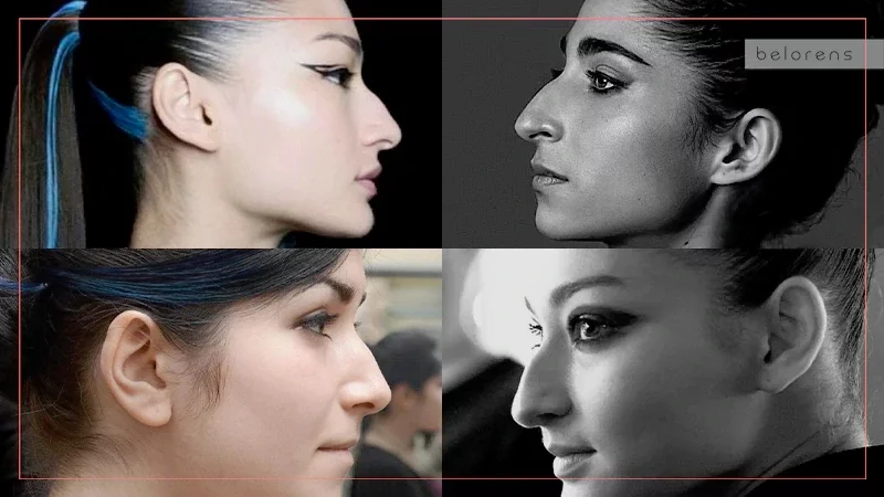 Types Of Nose Shapes Variations By Race And Ethnicity