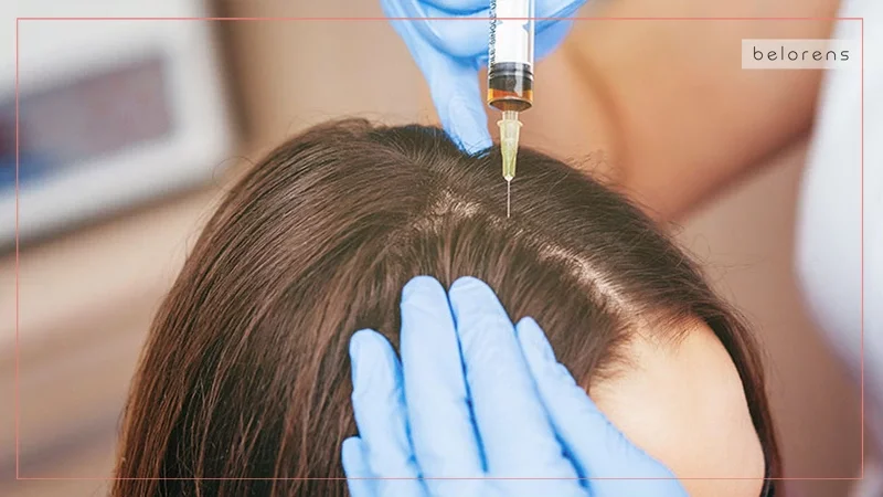 Steroid Injections for Hair Loss: Does It Work? | Belorens
