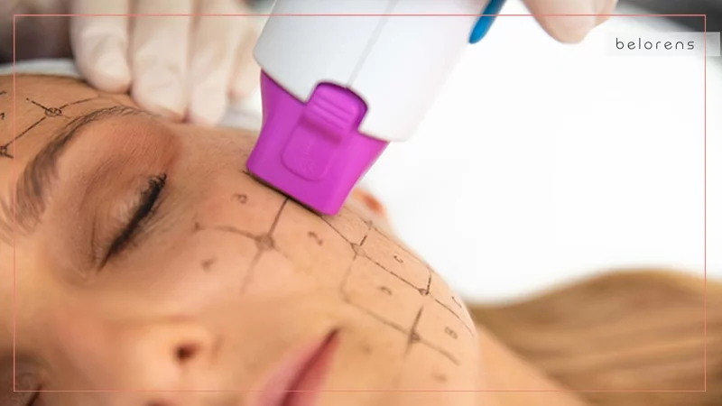 Thermage: Benefits, Procedure, Cost | Belorens