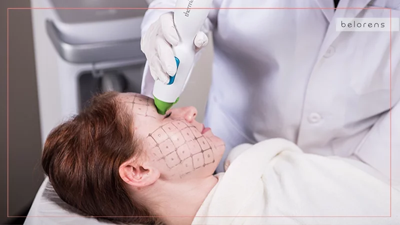 Thermage: Benefits, Procedure, Cost | Belorens